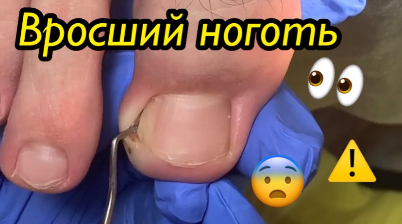 Вросший ноготь?⚠️?❗️??