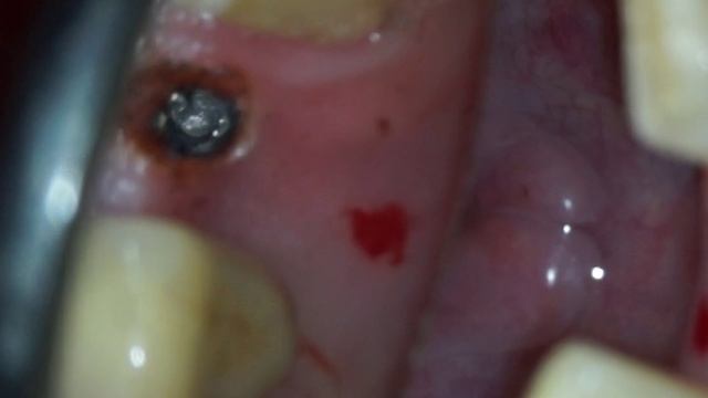 Сломанный винт в импланте