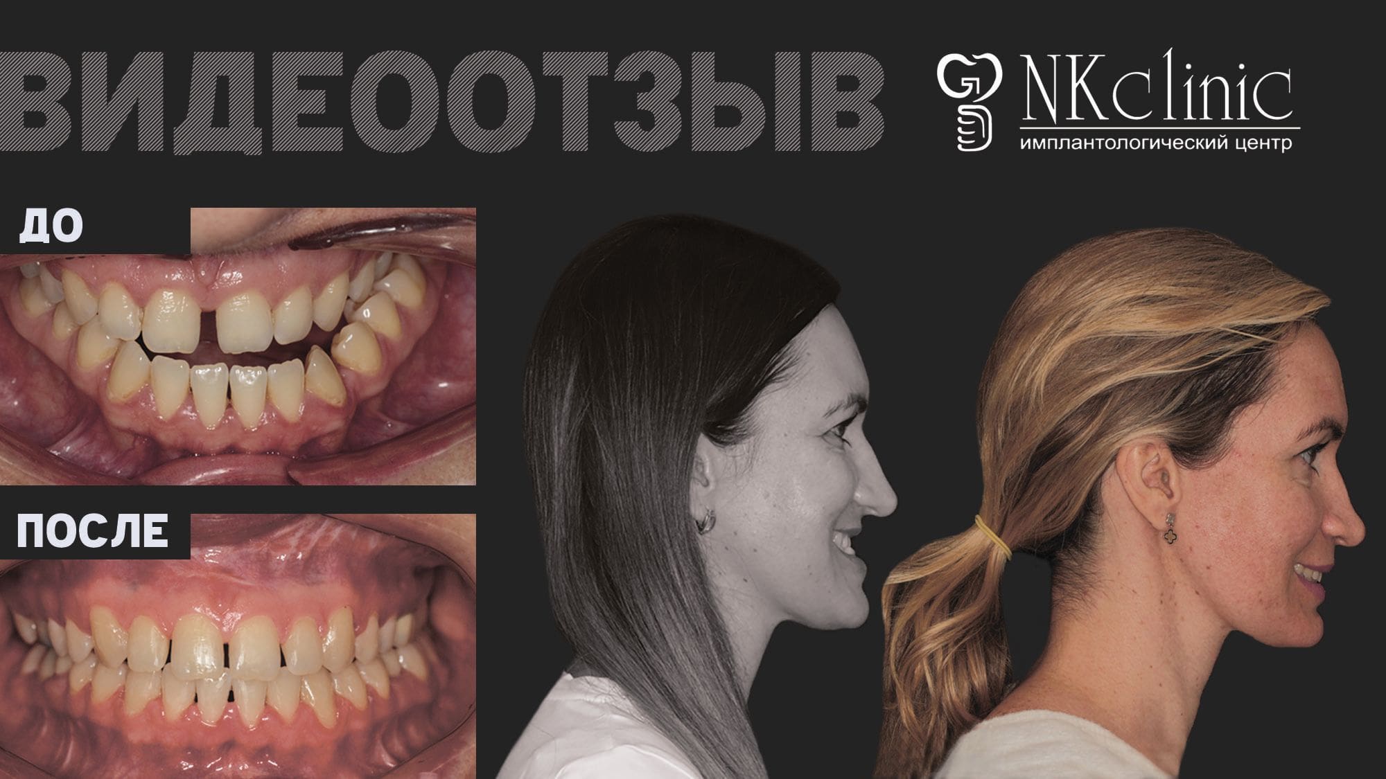 Ортогнатическое лечение большой нижней челюсти (перекрёстного мезиального прикуса)