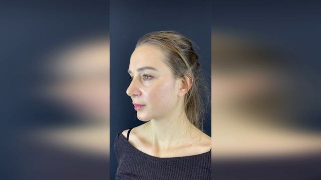 Два месяца после ринопластики