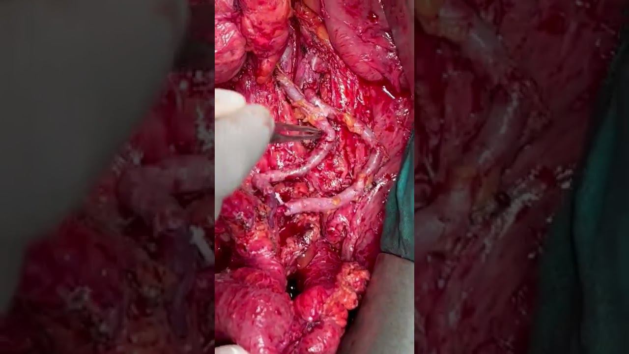 Аутотрансплантация тонкокишечного резервуара