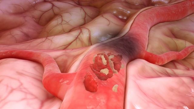 Видеофильм Карпова М. В. 309 пед. ПАТОГЕНЕЗ ЦЕРЕБРОВАСКУЛЯРНЫХ ЗАБОЛЕВАНИЙ.MOV