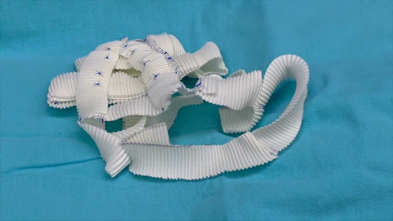 Имплантация "каркаса" - альтернатива трансплантации сердца