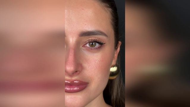 Два с половиной года после нижней трансконъюнктивальной блефаропластики