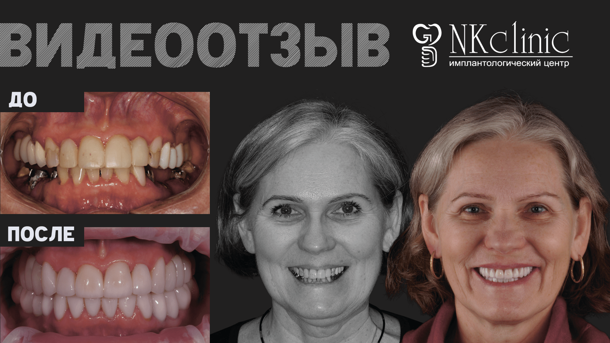 Тотальная имплантация и выравнивание на брекет-системе