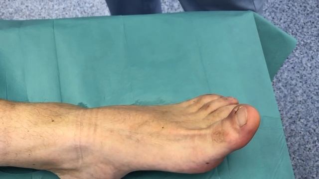 Анестезия по Оберсту-Лукашевичу при вросшем ногте. Anesthesia (Ingrown toenail)..mp4