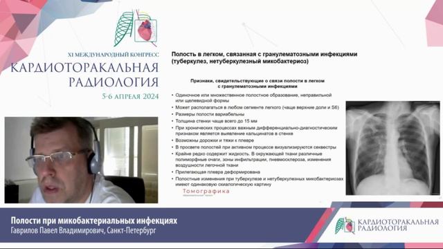 Полости при микобактериальных инфекциях
