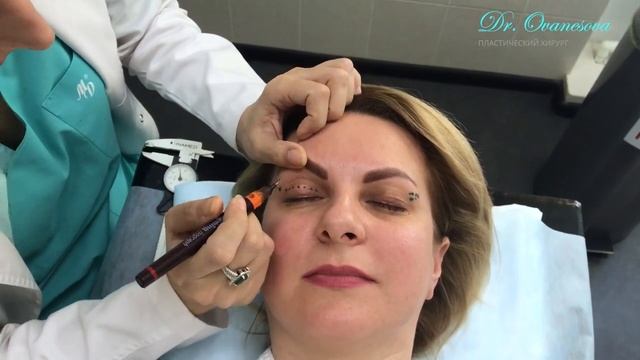 Пластика век. Разметка. Пациент № 54