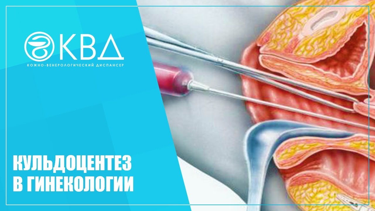 ✅ 1475  Кульдоцентез в гинекологии