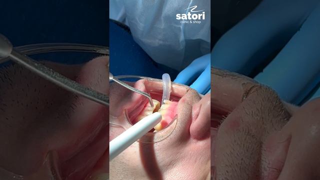 Чистка зубов перед брекетами