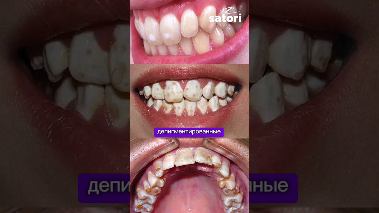 Гипоплазия эмали #зубы # стоматология #лечениезубов
