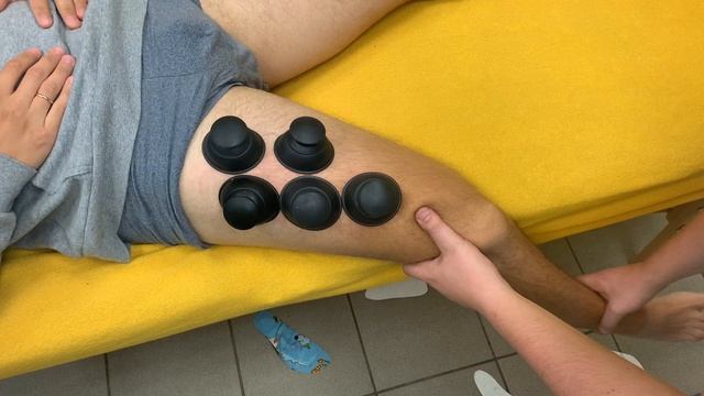 Четырехглавая мышца. Инструментальная мобилизация при помощи вакуумных банок. ИММТ Павел Коломиец.