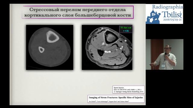 Стрессовые переломы, ошибки лучевой диагностики