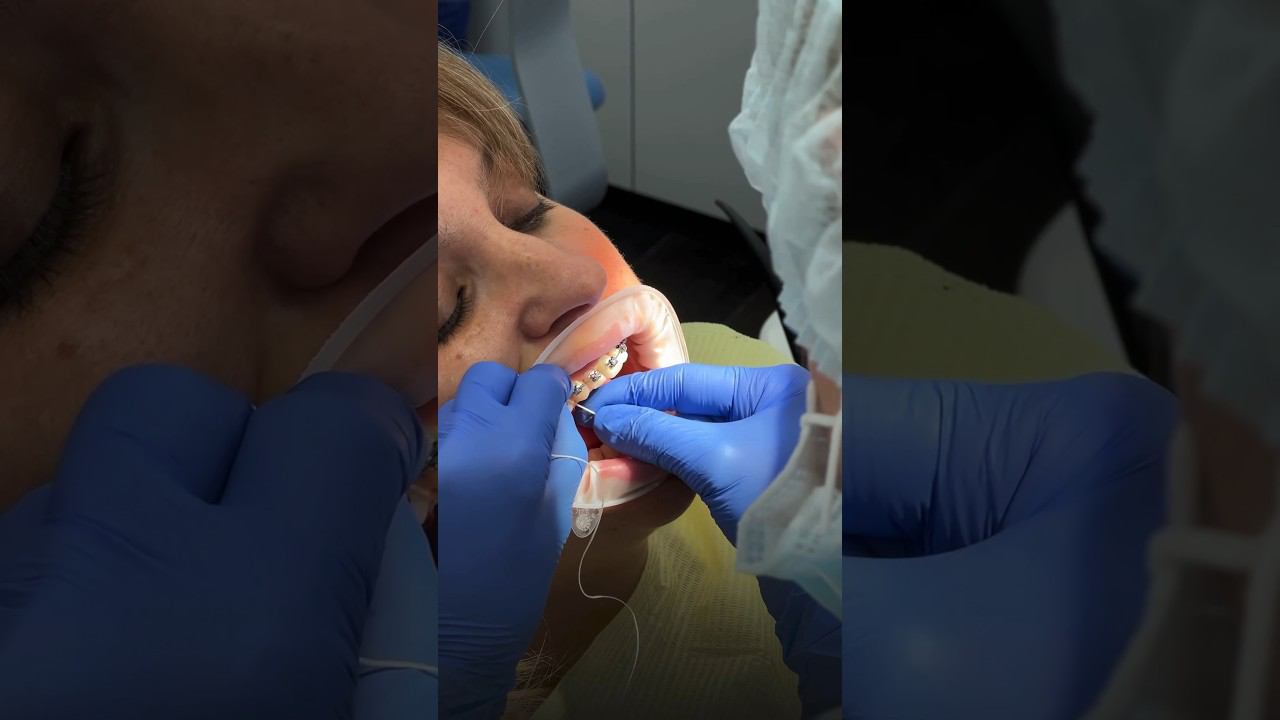 Как правильно ухаживать за зубами при ношении брекетов? #shorts ❤️ “СТОЛИЦА”  Москва, ЦАО