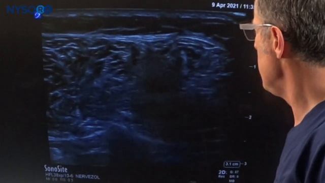 Поверхностный перонеальный нерв-блок.Superficial Peroneal Nerve Block - Crash course with Dr. Hadzic