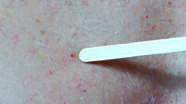 Что Такое Ангиомы