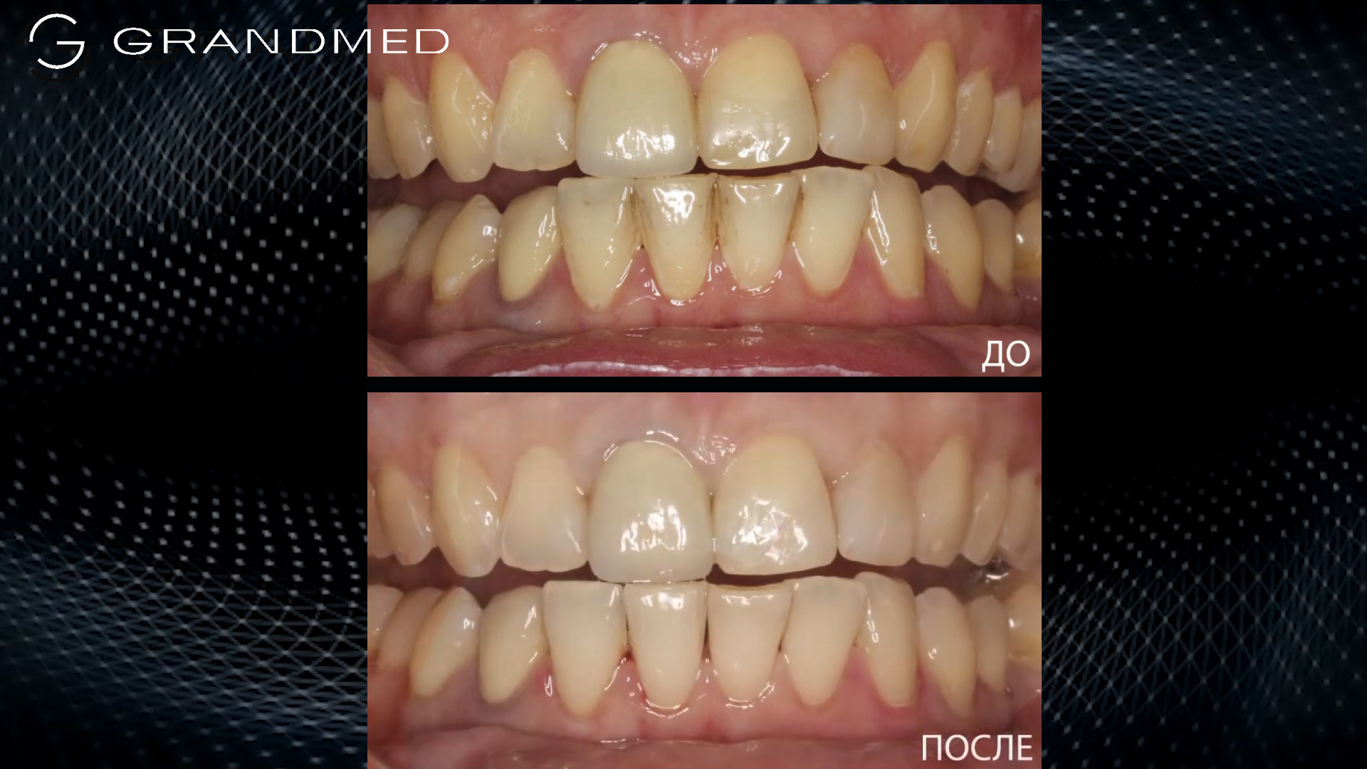 Профессиональная гигиена полости рта. До и после.