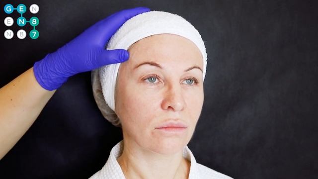 НИТЕВОЙ (ТРЕДЛИФТИНГ) ДЛЯ ПОДТЯЖКИ ОВАЛА ЛИЦА Сеть клиник инновационной косметологии GEN87