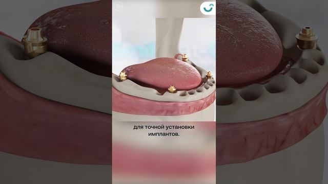 Имплантация всех зубов all-on-4 за 1 день. Как проходит лечение?  #allon4