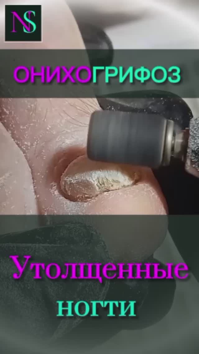 Онихогрифоз - утолщение ногтей.
Аппаратная обработка ногтей избавит от таких проблем✌️