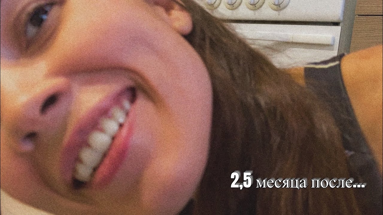 Период реабилитации после ожога. Тревога не оставляет…❤️_? один день с нами ❤️