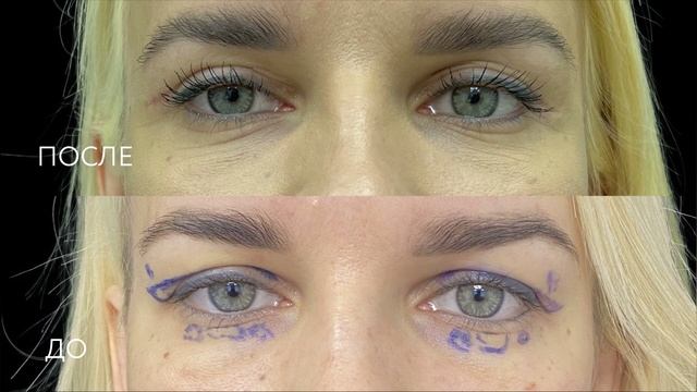 До и после круговой блефаропластики