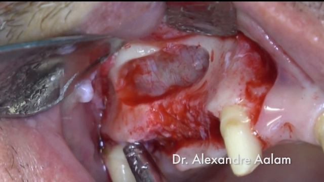 Открытый  синус-лифтинг менее чем за 5 минут с пьезохирургическим аппаратом
