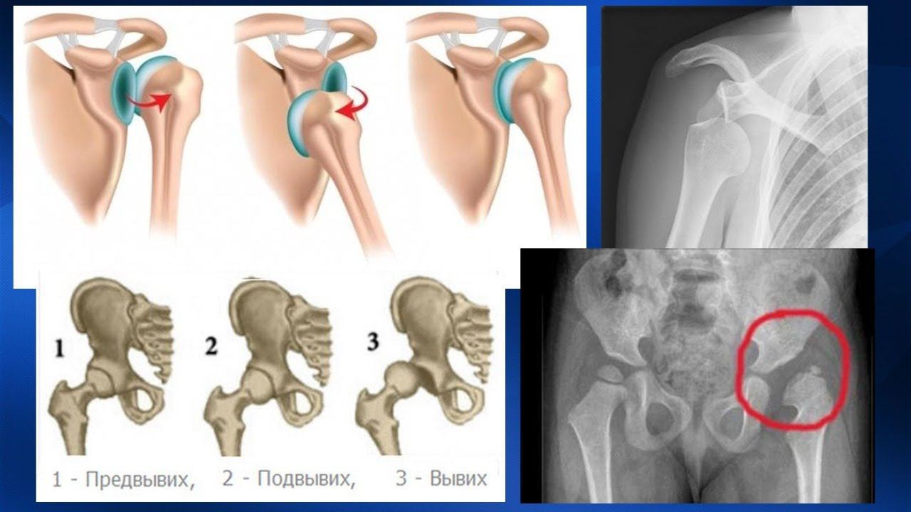 2.07. Массаж при вывихах | Медицинский массаж. Цикл 2
