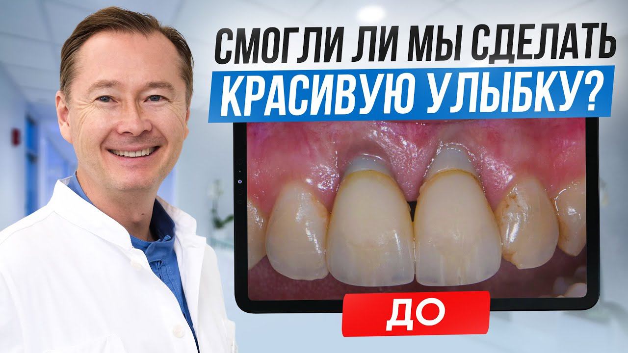 Смогли ли мы сделать красивую улыбку пациентке, которая была недовольна эстетическим результатом?