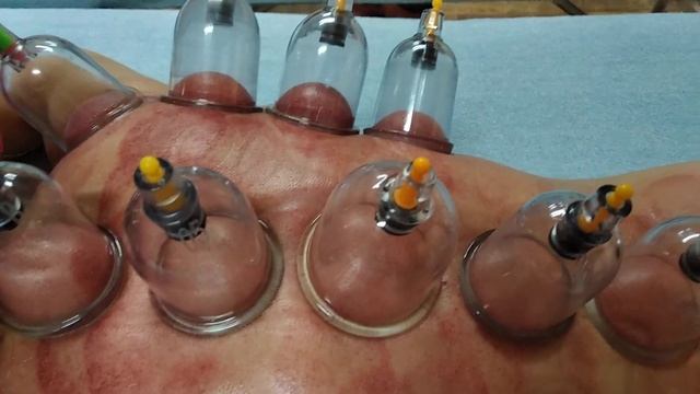 Вакуумные банки малышам.mp4