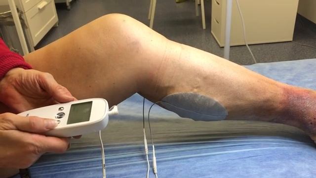 ?️  Аппарат Veinoplus V.I.. Лечение венозной язвы.mp4