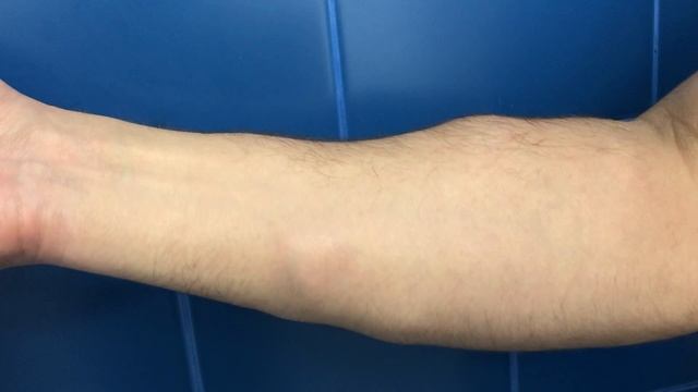 Липоматоз. Множественные липомы.