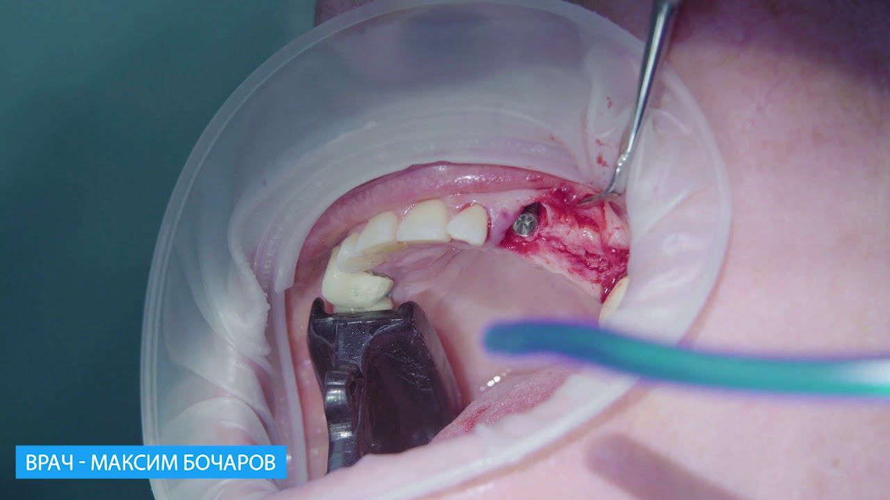 OneQ-SL. Одномоментная имплантация в области 23 зуба. Имплантация 25.