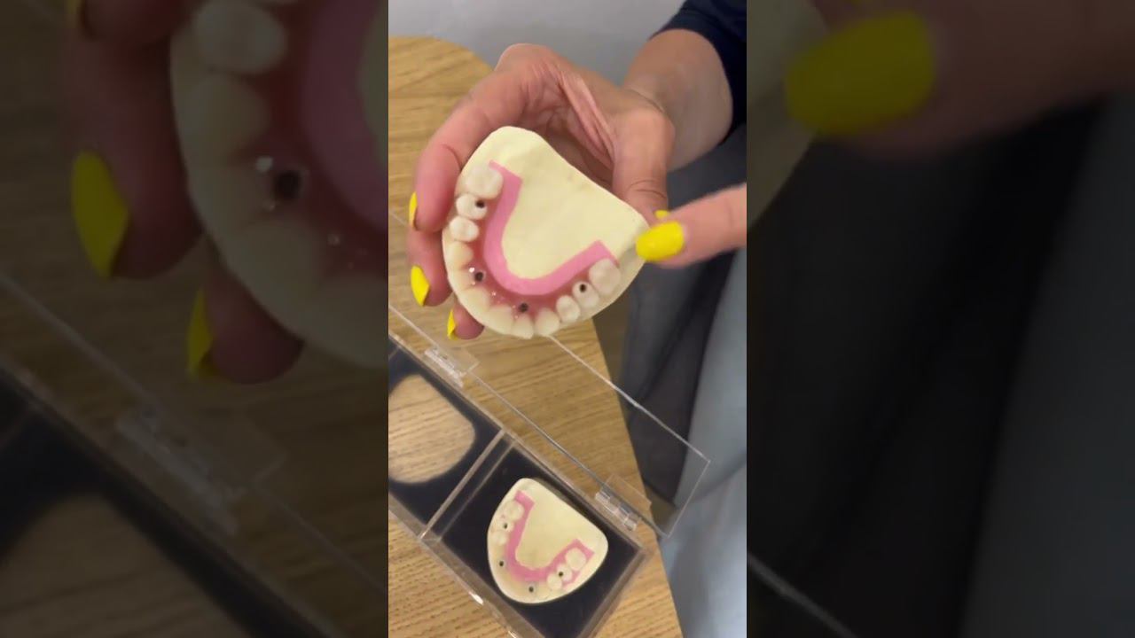 Виды несъемного протезирования для «все-на-4» и «все-на-6»