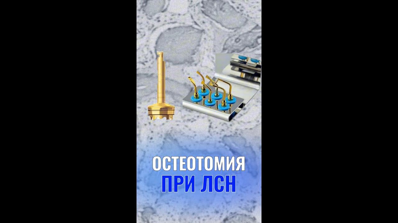 Остеотомия при латеральном синус-лифтинге