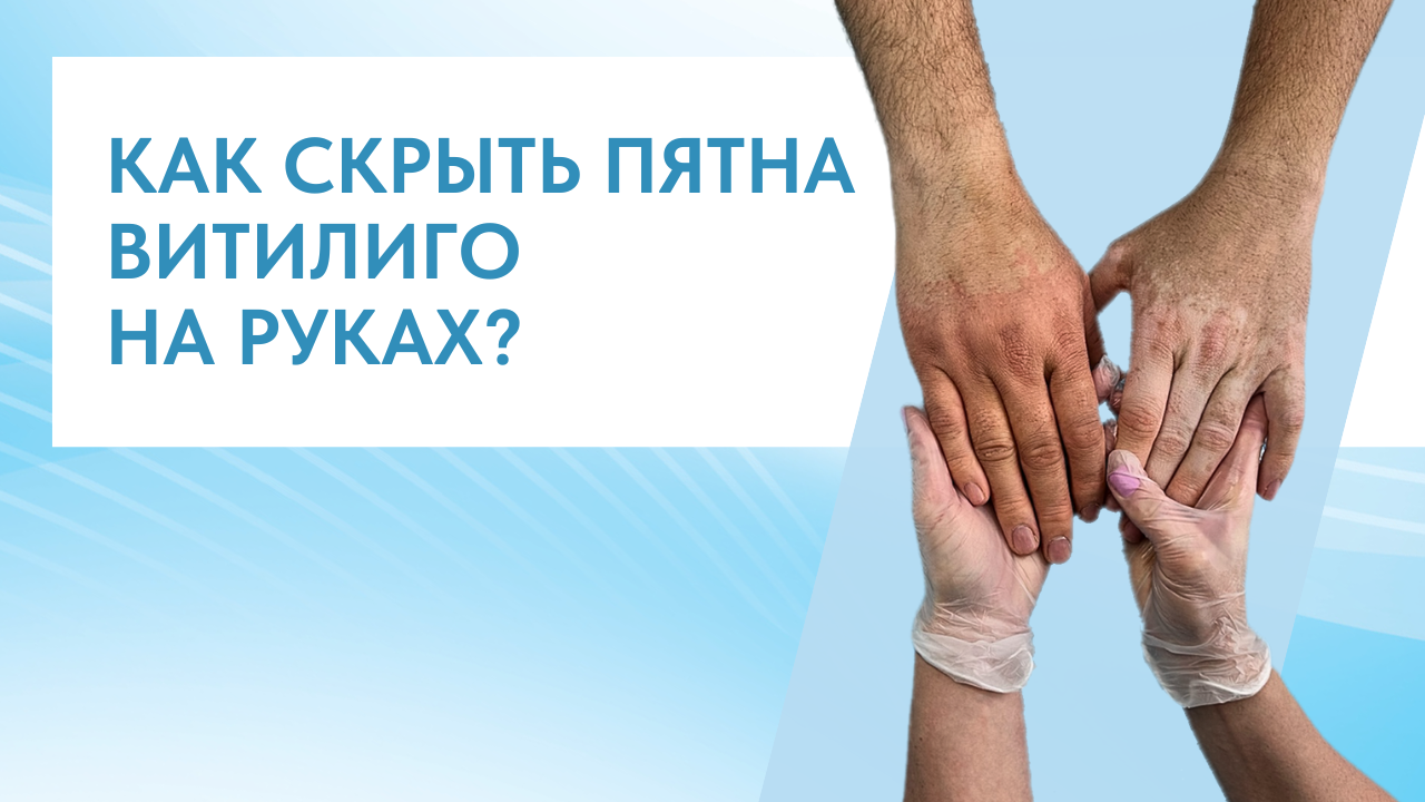ВИТИЛИГО НА РУКАХ | КАК СКРЫТЬ ВИТИЛИГО?