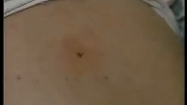 Прижигание