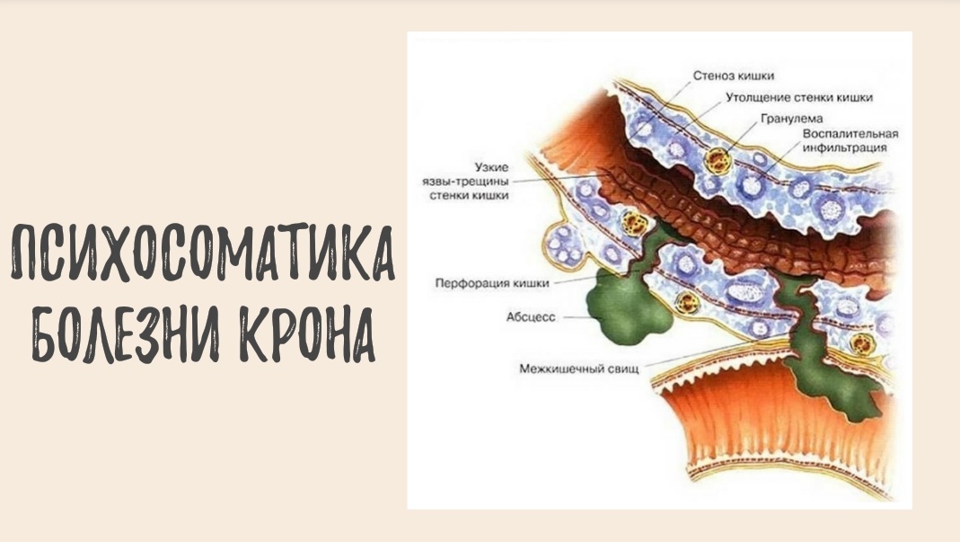 Психосоматика болезни Крона – болезнь Крона и ее настоящие причины.