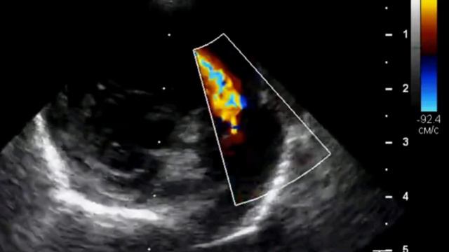 Аускультация собаки. Диастолический шум. Слушать в наушниках. Диагноз ОАП и синдром Эйзенменгера