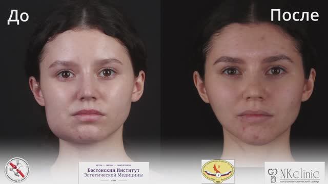 Удаление опухоли (амелобластической фибромы) нижней челюсти справа