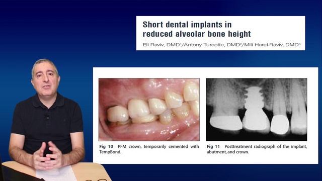 Короткие импланты: кому, зачем и когда (Длина импланта)