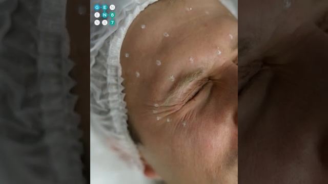 Морщины у мужчин на лбу и у глаз. Решение - инъекции Миотокс Клиника косметологии GEN87
