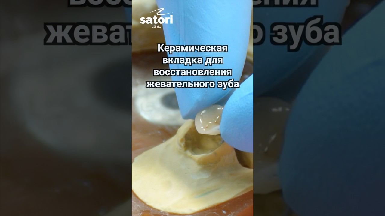 Керамическая вкладка для восстановления жевательного зуба  #зубы #стоматология