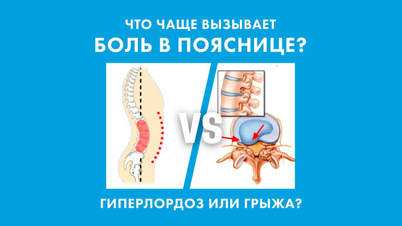 Боль в пояснице: всегда ли виновата грыжа? а может из-за гиперлордоза?