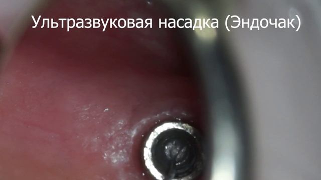 Удаление сломанного винта шаровидного абатмента из имплантата Anthogyr с помощью набора MFR KIT