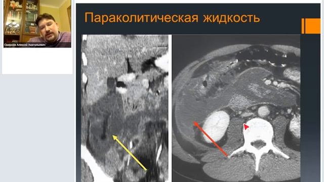 Острый аппендицит.  Предотвращение ошибок в диагностике.mp4