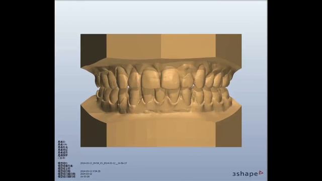 Лингвальная брекет-система eBrace
