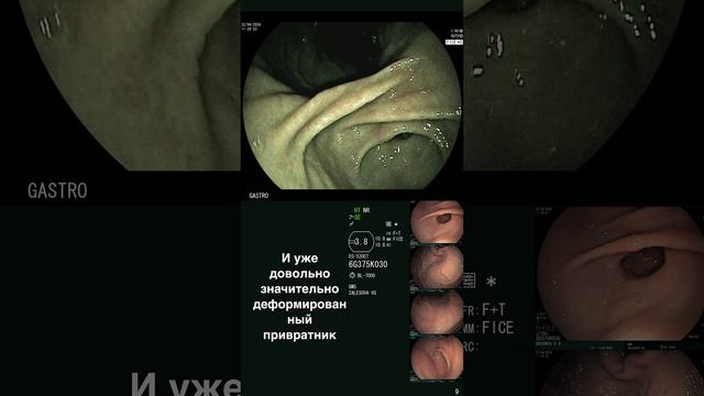 Загадочное воспаление ЖКТ гастроскопия