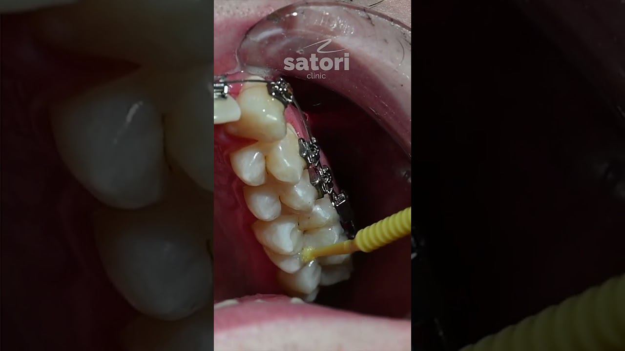 Окклюзионные накладки на зубы