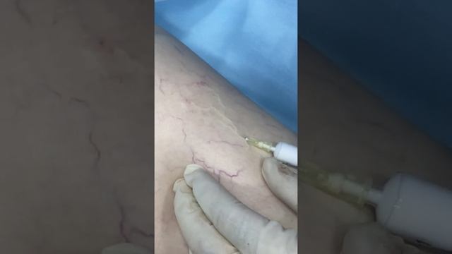 #варикознаяболезнь #склеротерапия #варикозноерасширениевен #беременность #отеки #флеболог #лазерноел